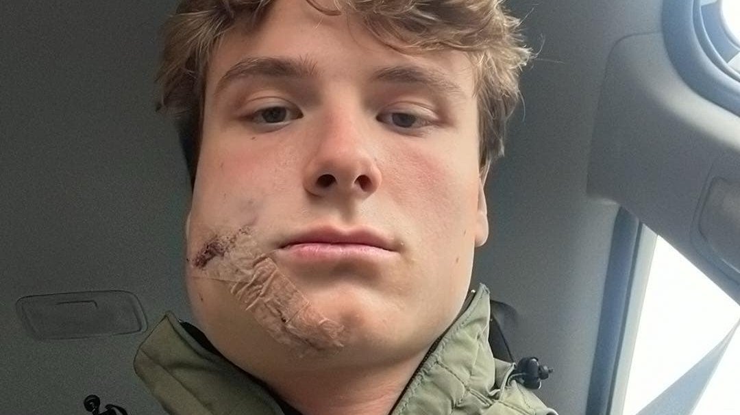 Christopher Mulberg ramt af skøjte i ansigtet - opereret på Rigshospitalet